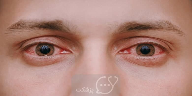 فلورومتولون || پزشکت